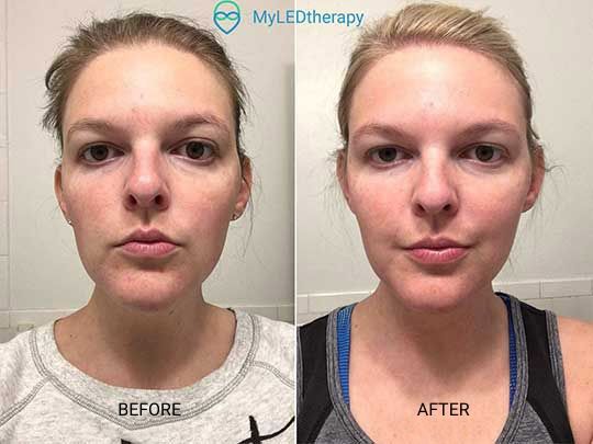 LED Face Mask Before And After | MyLEDtherapy | LED Light Therapy