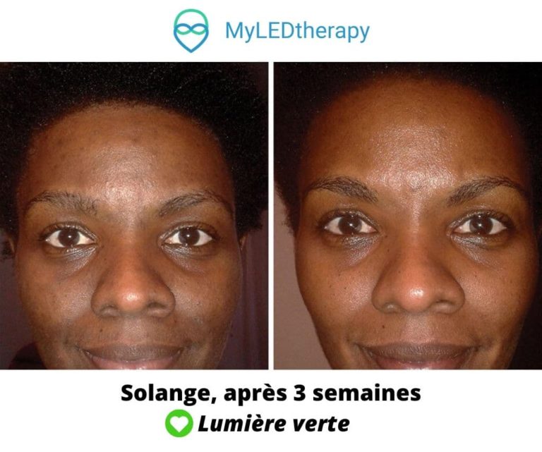 LED Face Mask Before And After | MyLEDtherapy | LED Light Therapy