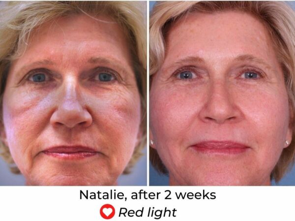 LED Face Mask Before And After - MyLEDtherapy - LED Light Therapy ...