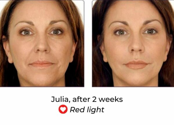 LED Face Mask Before And After - MyLEDtherapy - LED Light Therapy ...