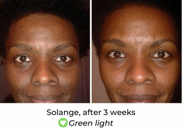 LED Face Mask Before And After | MyLEDtherapy | LED Light Therapy