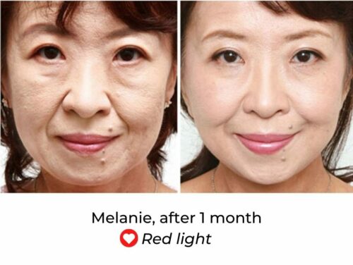 LED Face Mask Before And After - MyLEDtherapy - LED Light Therapy ...