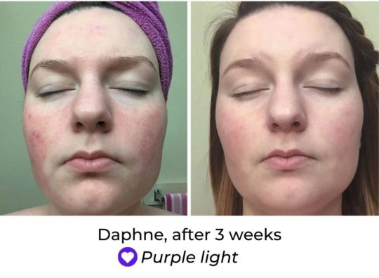 LED Face Mask Before And After - MyLEDtherapy - LED Light Therapy ...