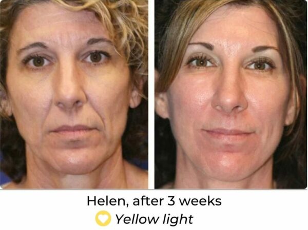 LED Face Mask Before And After | MyLEDtherapy | LED Light Therapy
