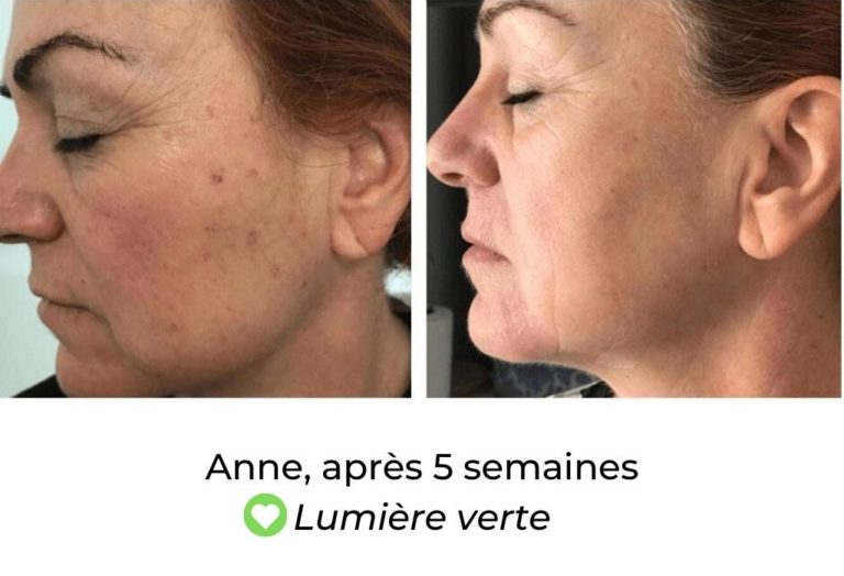 Masque Led Visage Avant Aprs
