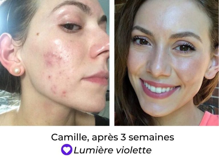 Masque LED Visage avant après - MyLEDtherapy - Masque LED Avis